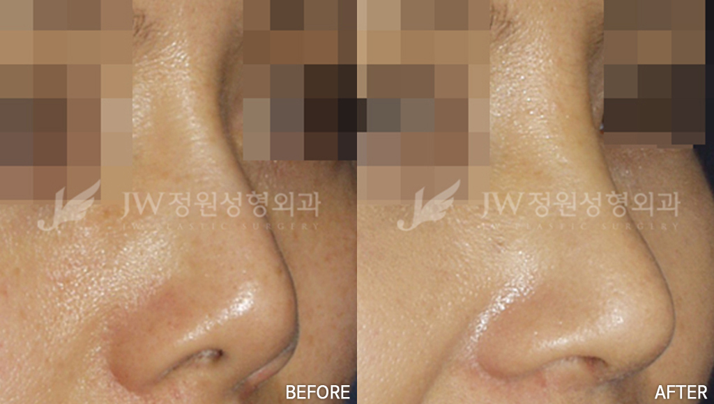 Nose Surgery - Rhinoplasty, Upturned Nose Correction, Tip Extension (A ...
