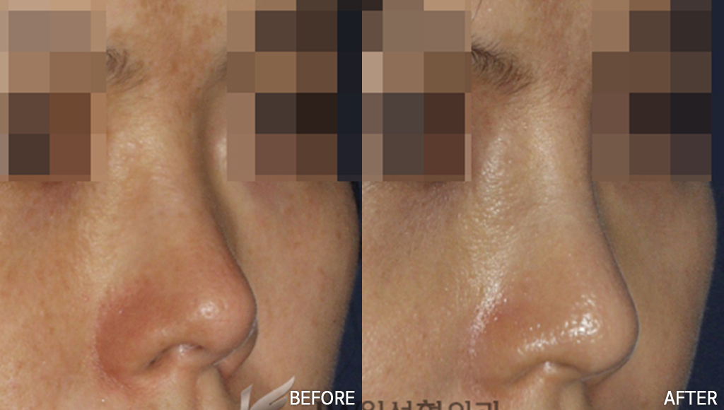 Nose Surgery - Rhinoplasty, Silicone Implant Tip Plasty (F) - JW Thai