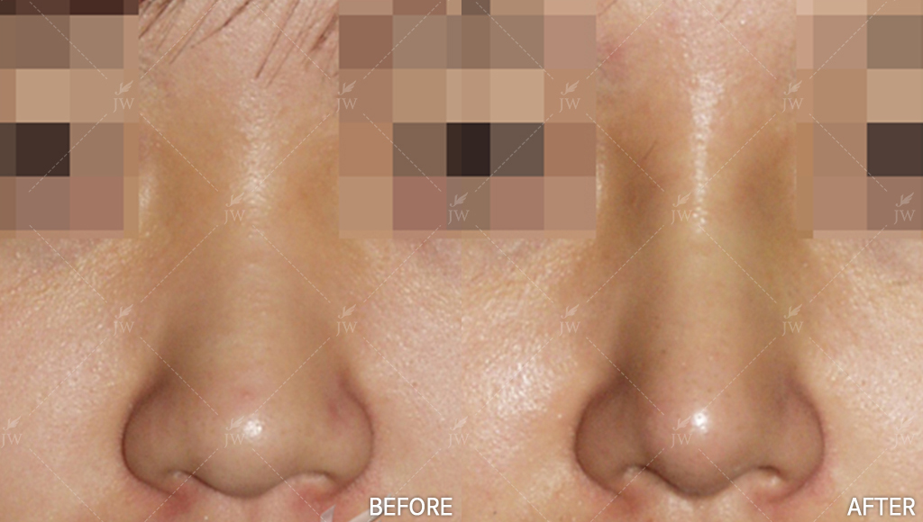 Nose Surgery - Rhinoplasty, Silicone Implant Tip Plasty (N) - JW Thai